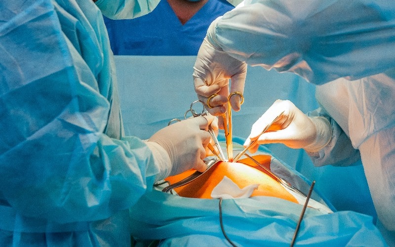 ¿Cuándo se produce peritorinitis? – Cirujano General Quito